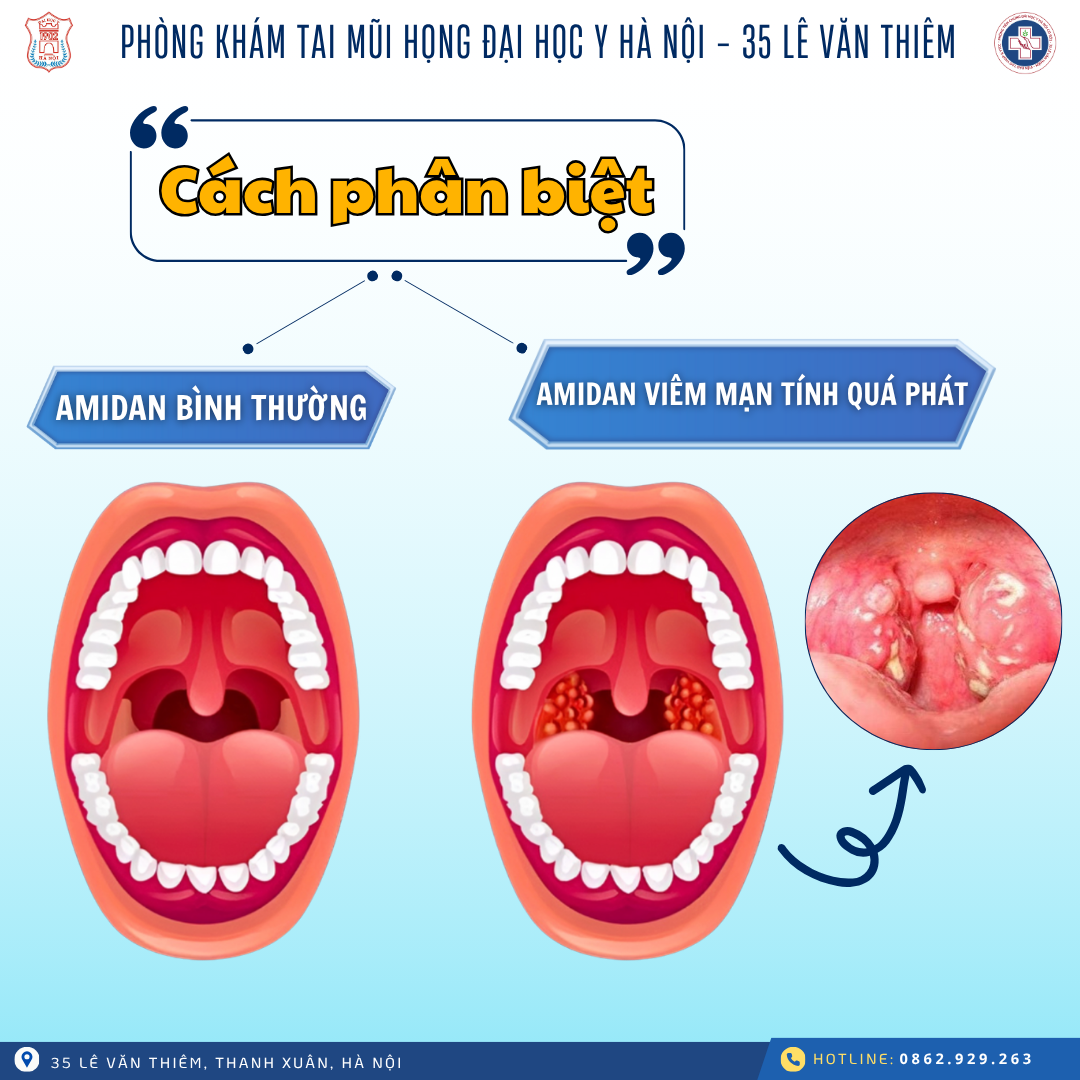 CẮT AMIDAN CÓ LÀM CON MẤT ĐI "LÁ CHẮN" BẢO VỆ CƠ THỂ